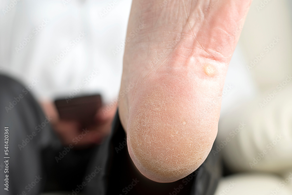 Woman's foot with cracks and rough skin on the heels. Close-up. Health ...