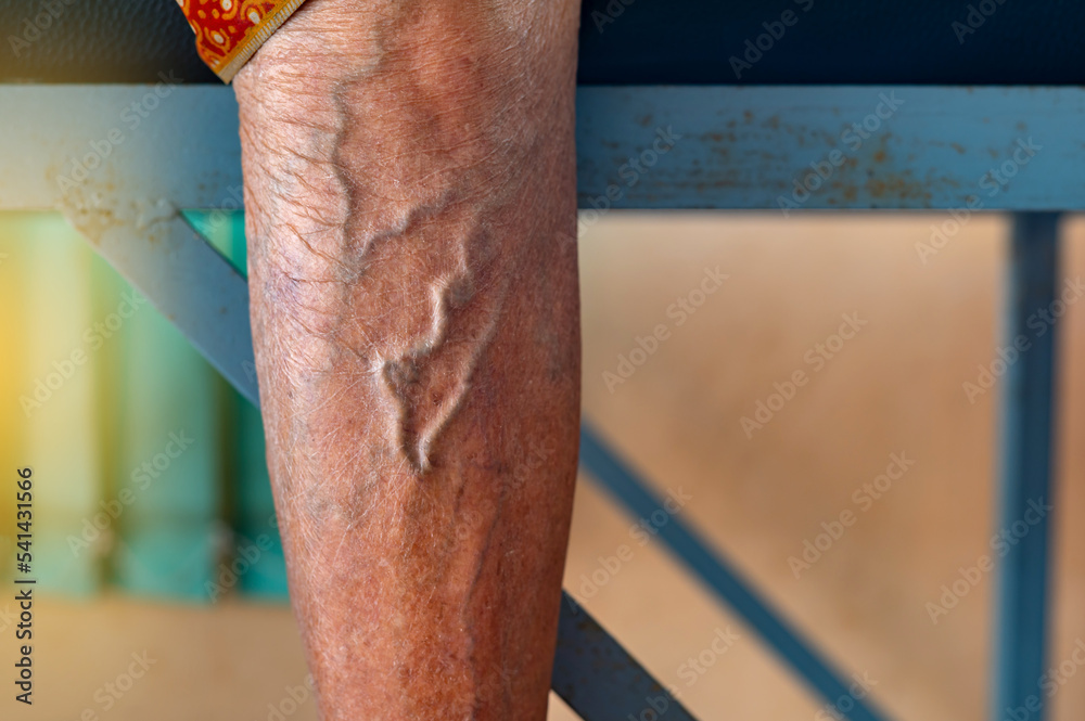 Foto de Close up Varicose veins in the elderly.The severity of the ...