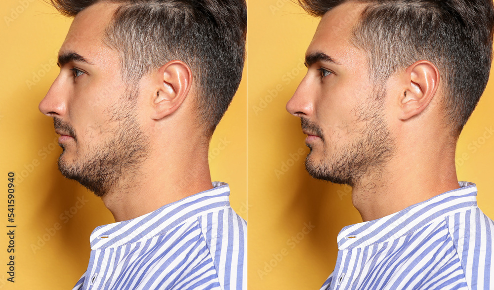 Double chin problem. Collage with photos of man before and after ...