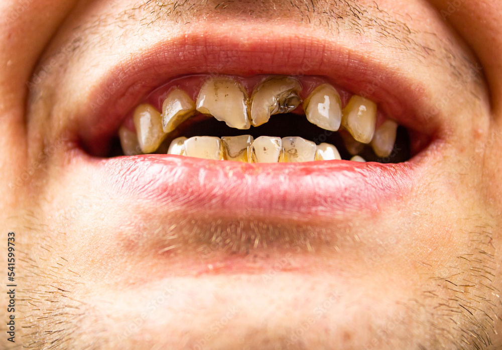Broken teeth in a man close-up. Chipped teeth. Dental problems with ...