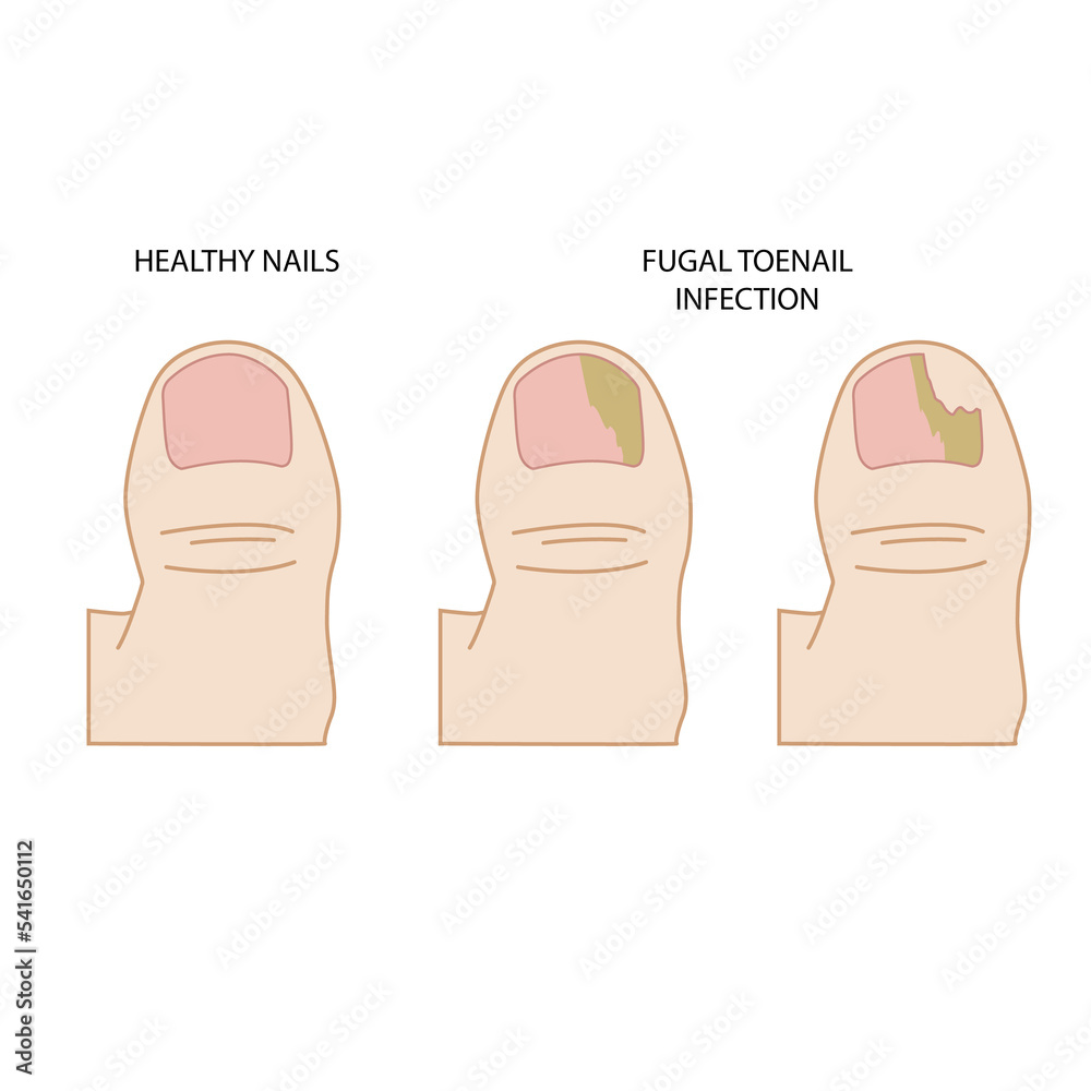 Healthy and fungal toenail infection, illustration isolated on white ...