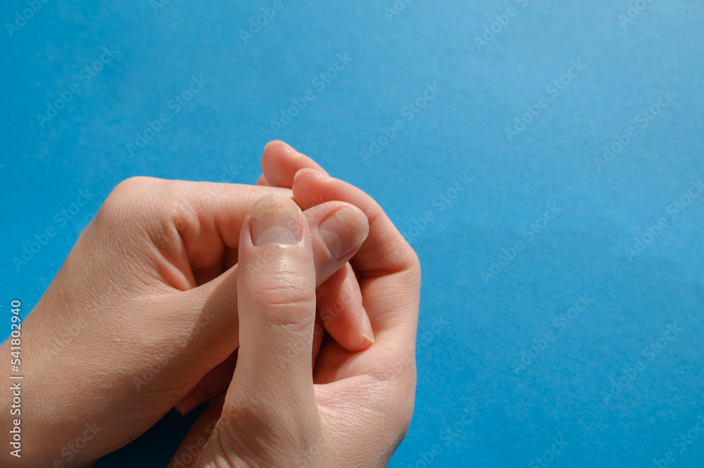 Hands on a blue background with nail lesions - onycholysis.Separation ...
