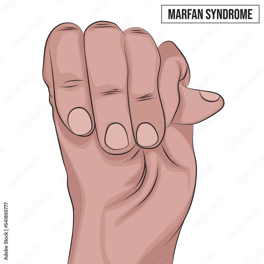 Marfan syndrome affects the heart, eyes, blood vessels, and bones ...
