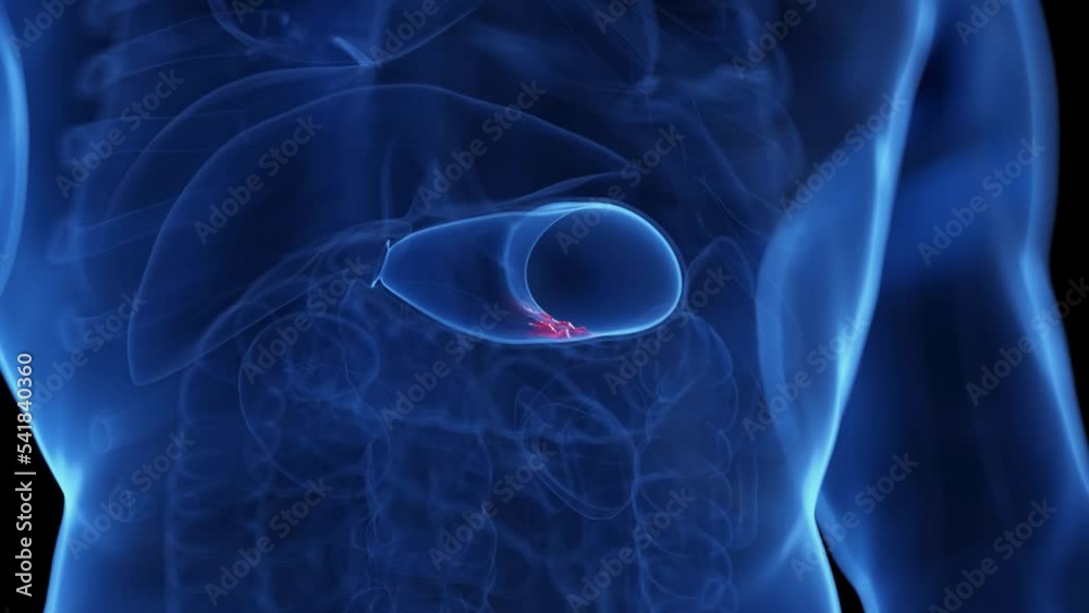 3d rendered medical animation of a stomach ulcer Stock Video | Adobe Stock