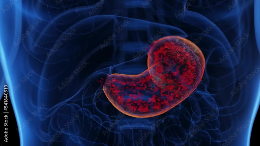 3d rendered medical animation of a stomach infection Stock Video ...