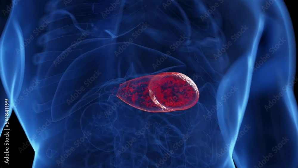 3d rendered medical animation of a stomach infection Stock Video ...