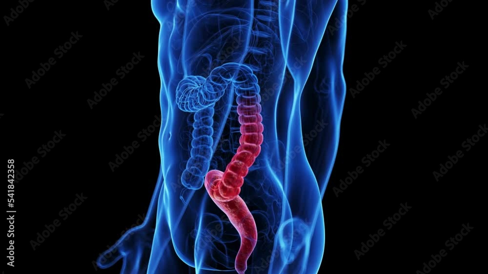 3d rendered medical animation of the colon of a man suffering from ...