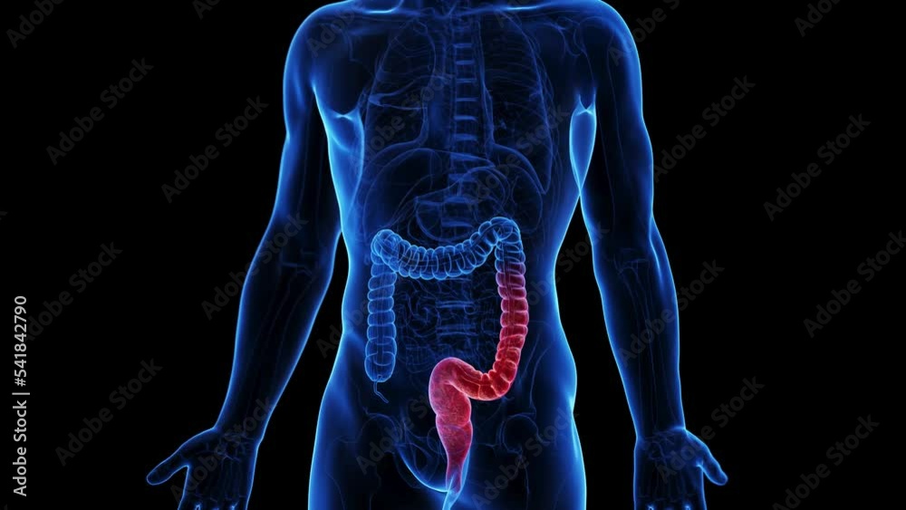 3d rendered medical animation of the colon of a man suffering from ...