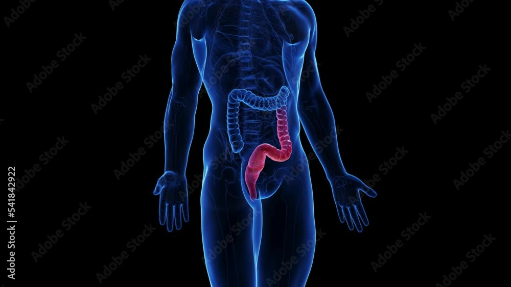 3d rendered medical animation of the colon of a man suffering from ...