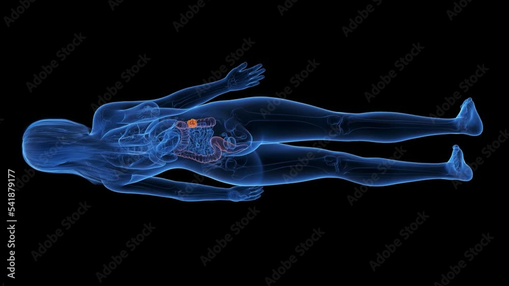 3d rendered medical animation of a colon tumor Stock Video | Adobe Stock