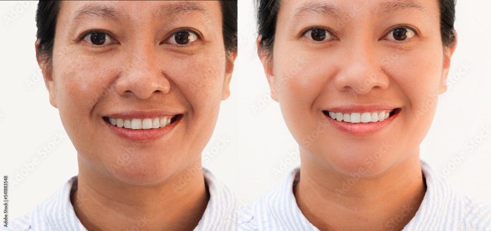 Retouched image to show before and after treatment spot melasma ...
