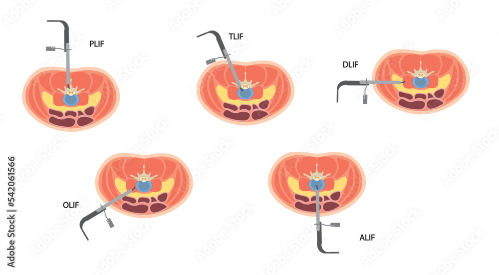 Lumbar Interbody Fusion (LIF). Spine surgery performade by a endoscopy ...