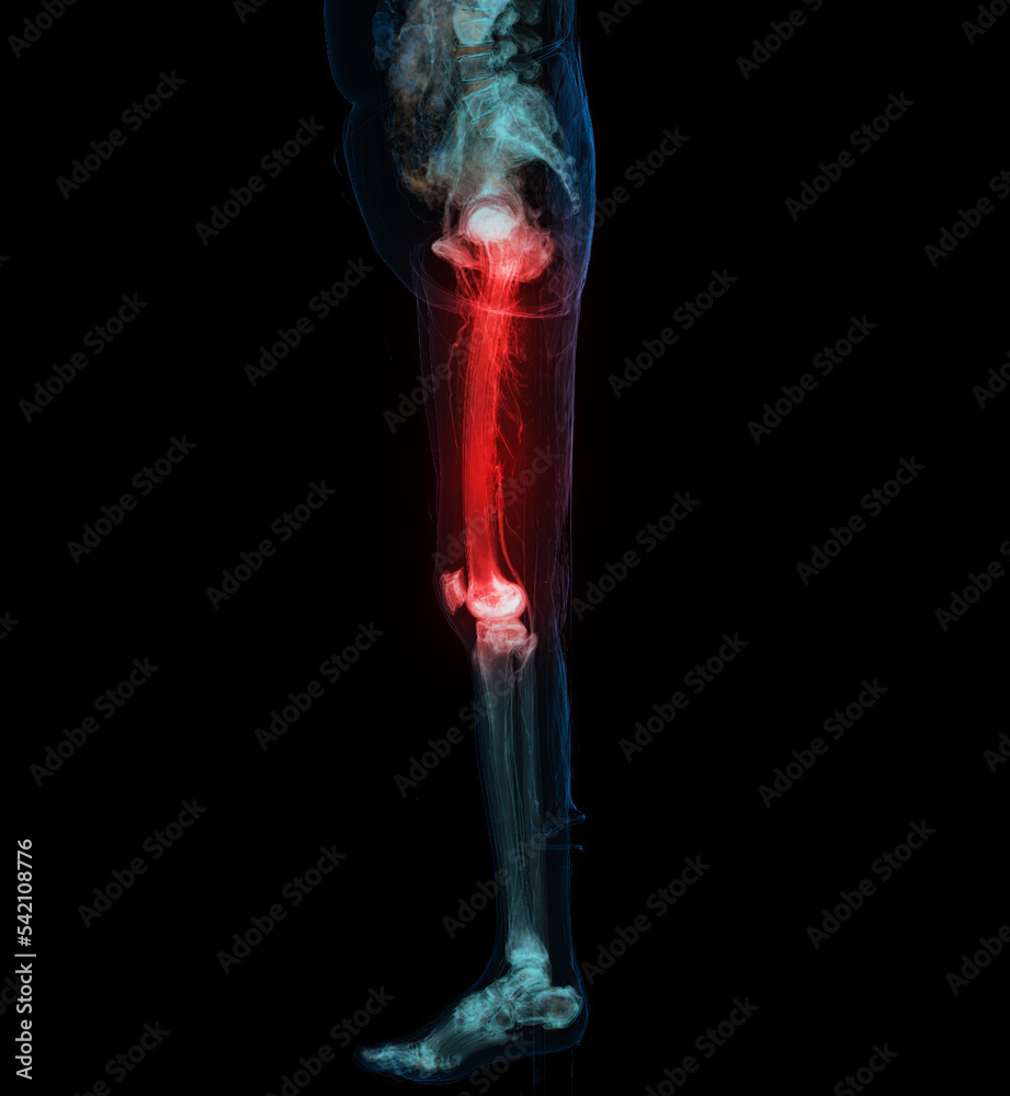 CT scan of lower extremity ,3D illustration of Femur bone , knee joint ...