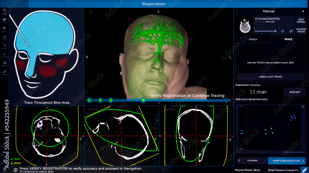 Step by step Visualase is an MRI-guided laser ablation system used to ... Step by step Visualase is an MRI-guided laser ablation system used to ...