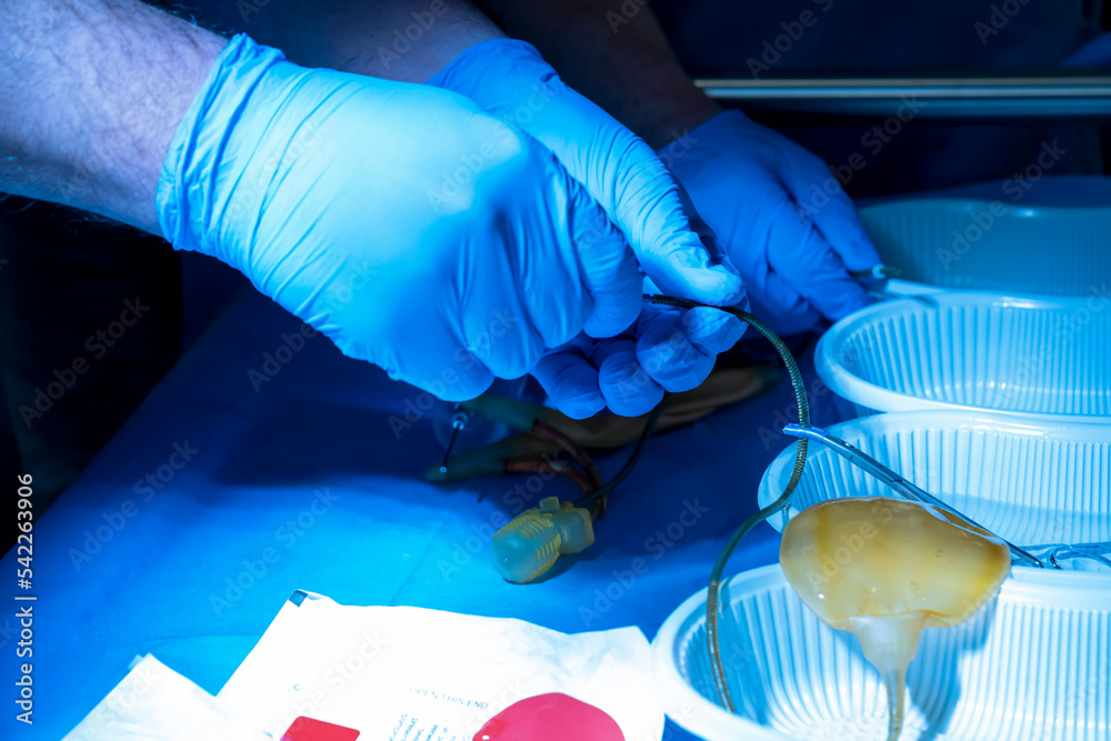 penis penile implant, penis enlargement surgery, balloon insertion ...