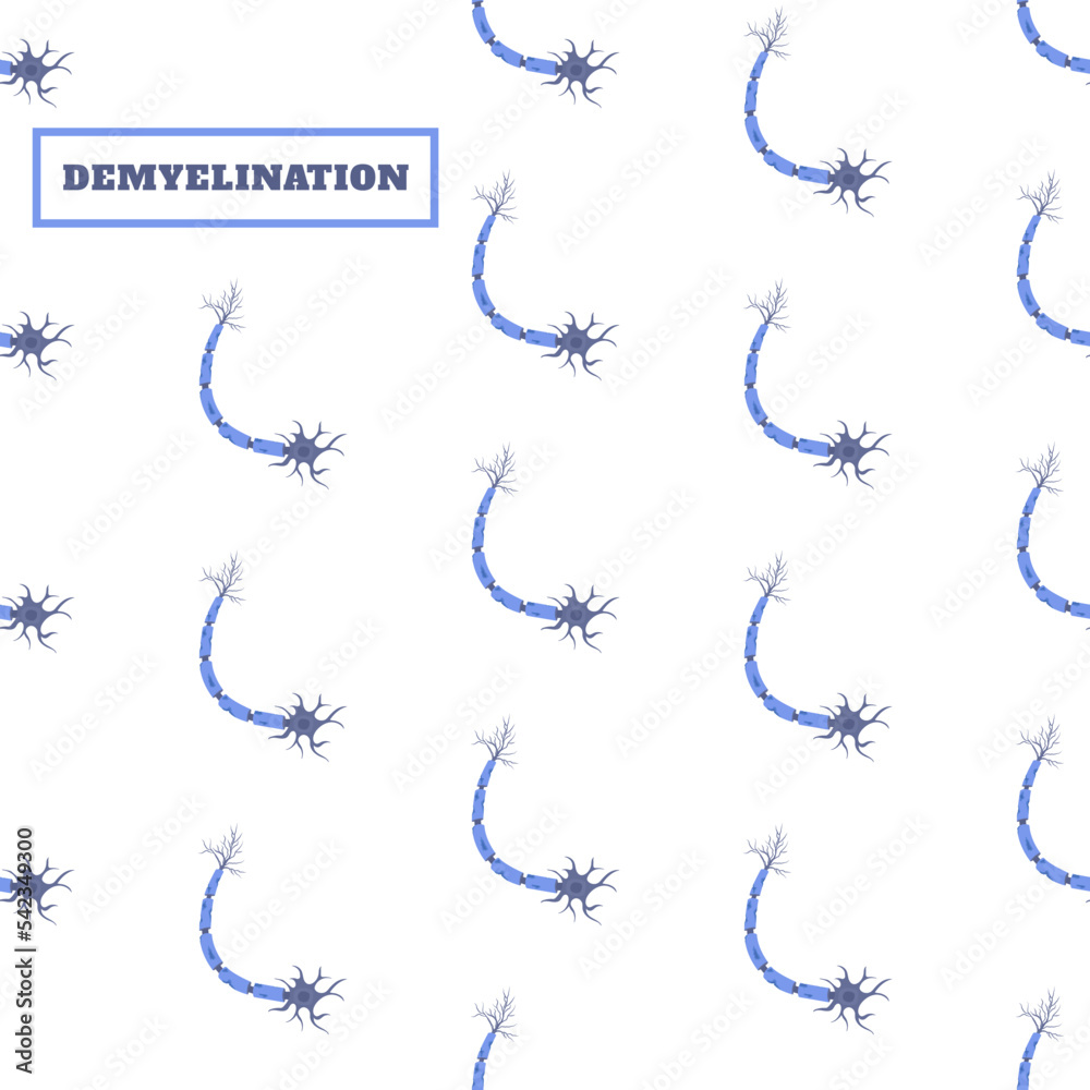 Demyelination. Neuron myelin sheath damage due to inflammation ...