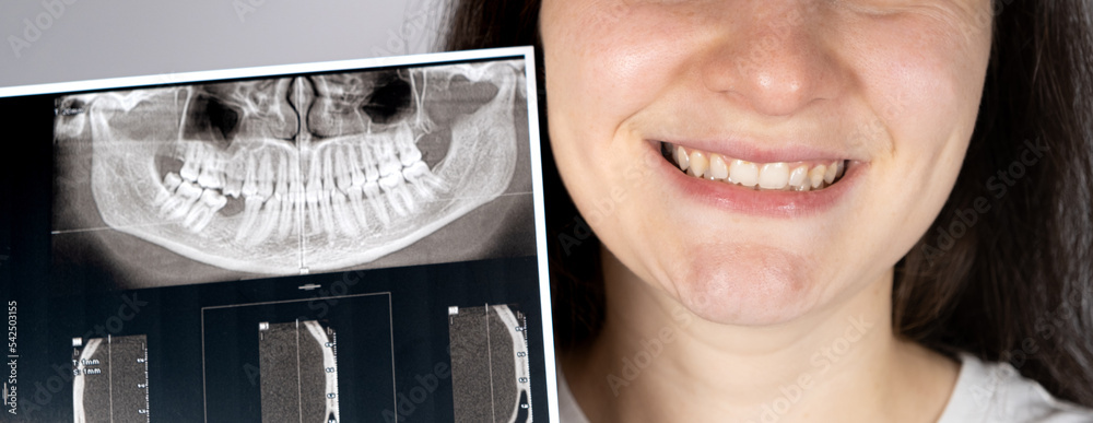 A patient with malocclusion, missing chewing tooth and ...