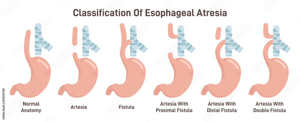 Esophageal atresia types set. Congenital medical condition of trachea ...