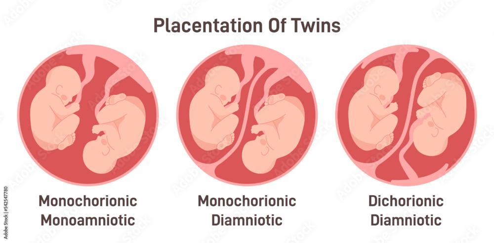Twin types. Monozygotic or dizygotic placentation of twins ...