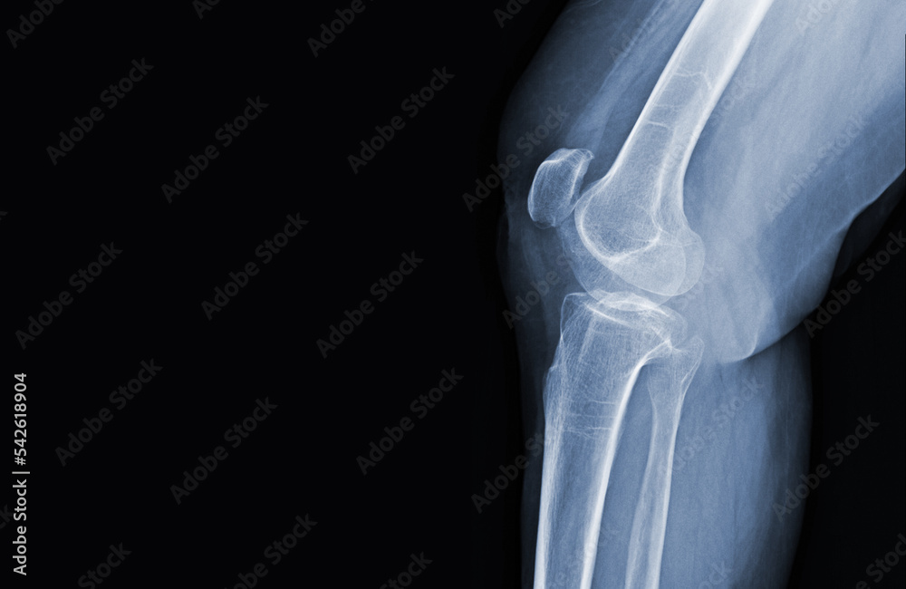 Film x-ray of human knee normal joints and ligaments Medical image ...