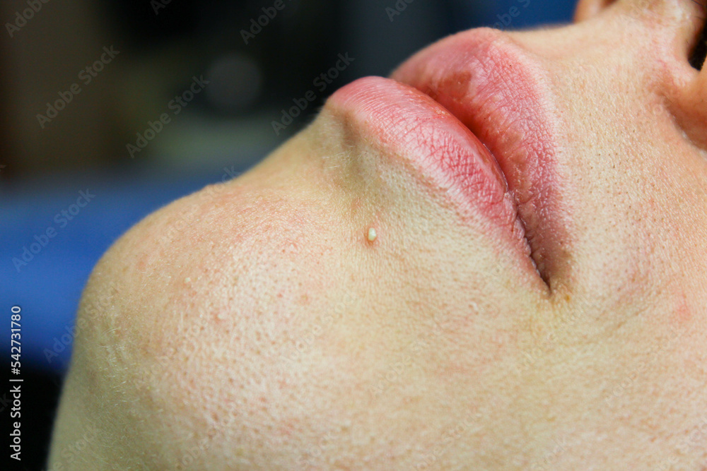 cosmetology. facial skin pollution disappears. clogged sebaceous glands ...