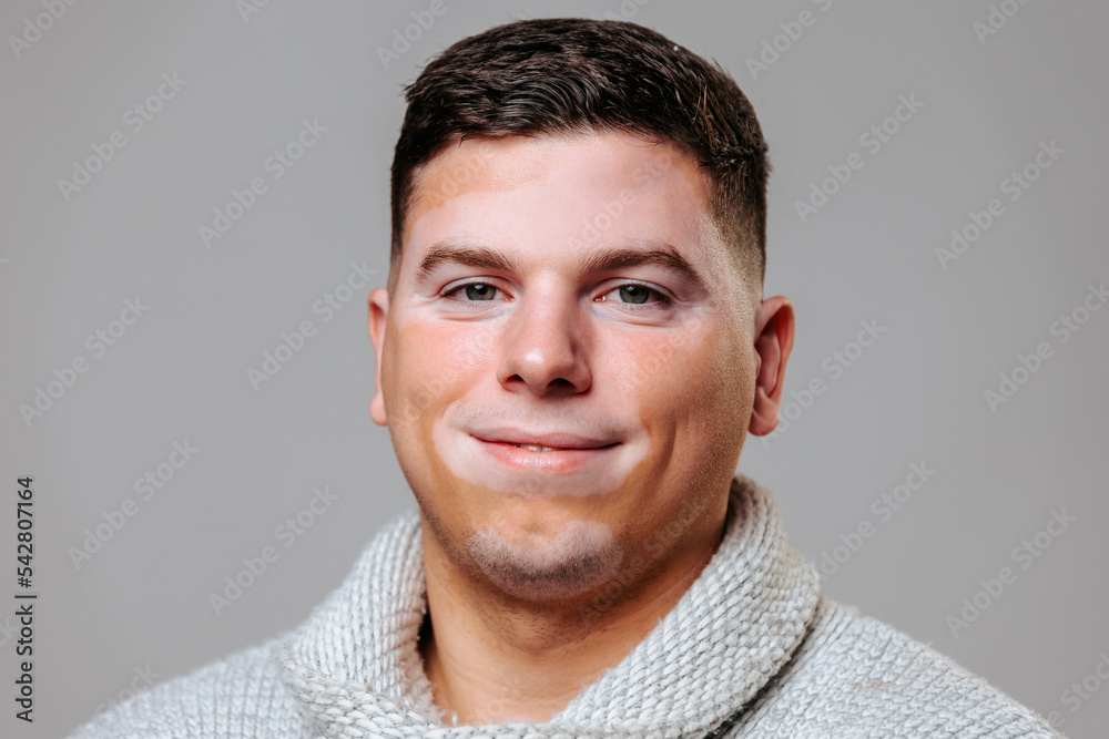 Male vitiligo fashion portrait young man made in the studio smiling and ...