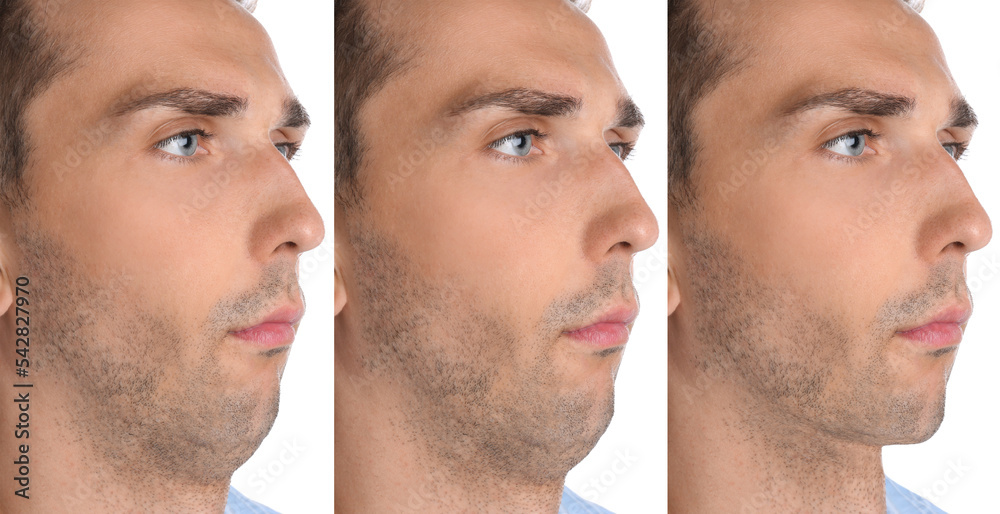 Double chin problem. Collage with photos of man before and after ...