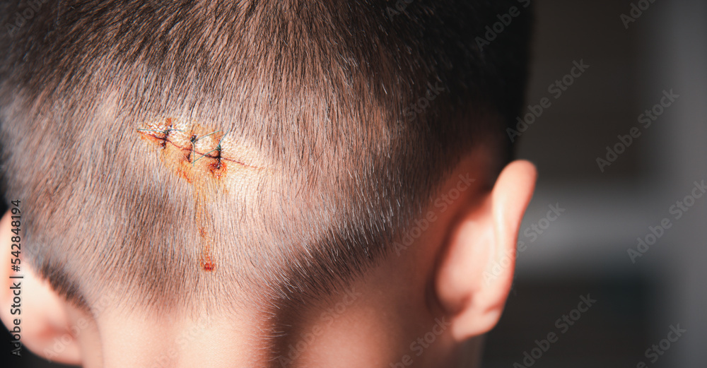 The lacerated sutured wound of kid back head which suture by nylon ...