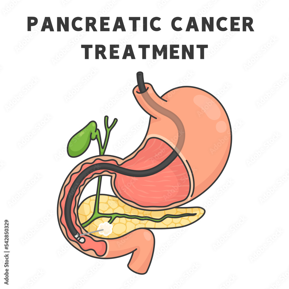 pancreatic cancer treatment chart in science subject kawaii doodle ... pancreatic cancer treatment chart in science subject kawaii doodle ...