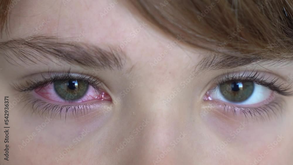 Close up eyes teenager boy with red irritated inflamed eye burst vessel ...