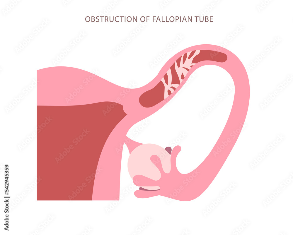 Poster Flat chart of Fallopian tube obstructed – Wall Art | UkPosters