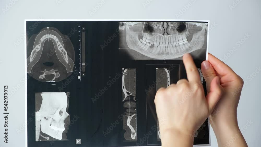 Doctor showing a CT scan of a patient with temporomandibular joint ...