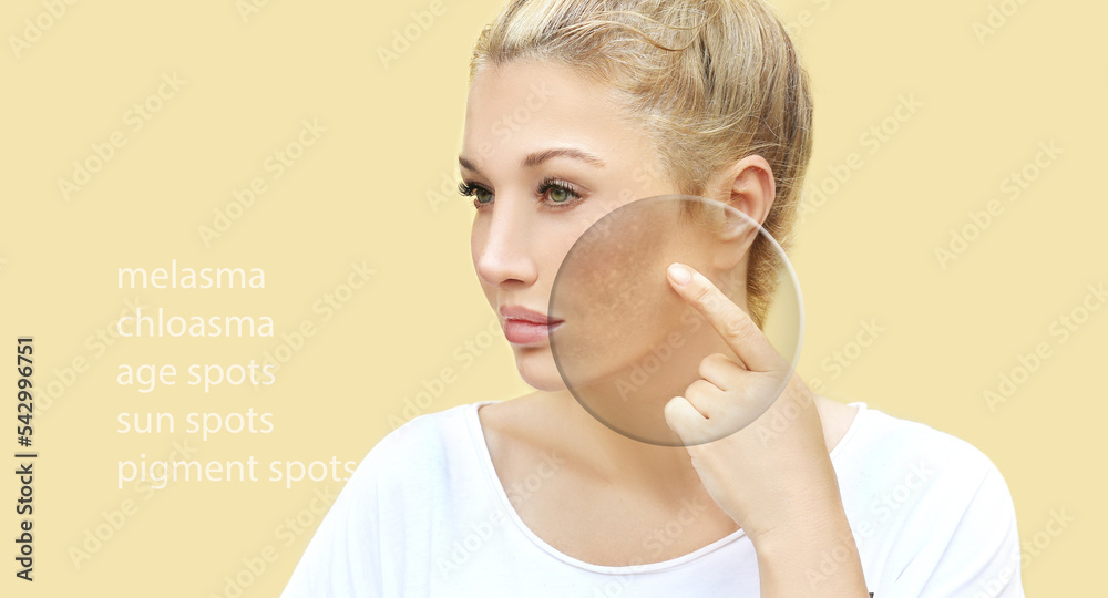 Dark spots, freckles,hyperpigmentation(melasma or chloasma),concept ...