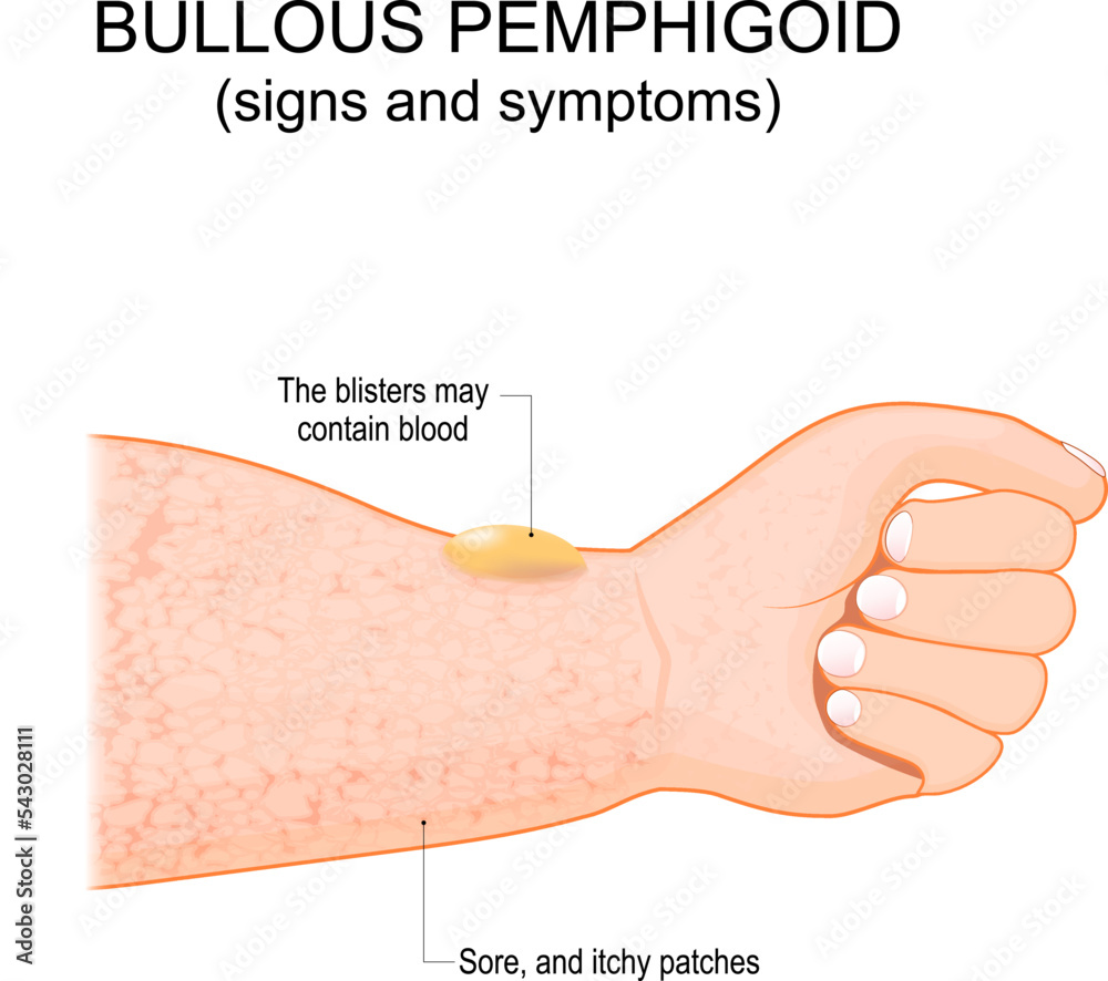 Vecteur Stock Bullous pemphigoid. autoimmune pruritic skin disease ...