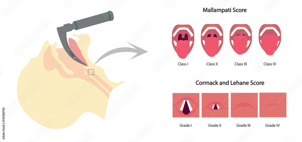 Vettoriale Stock Airway managment illustration.Intubation with ... Vettoriale Stock Airway managment illustration.Intubation with ...