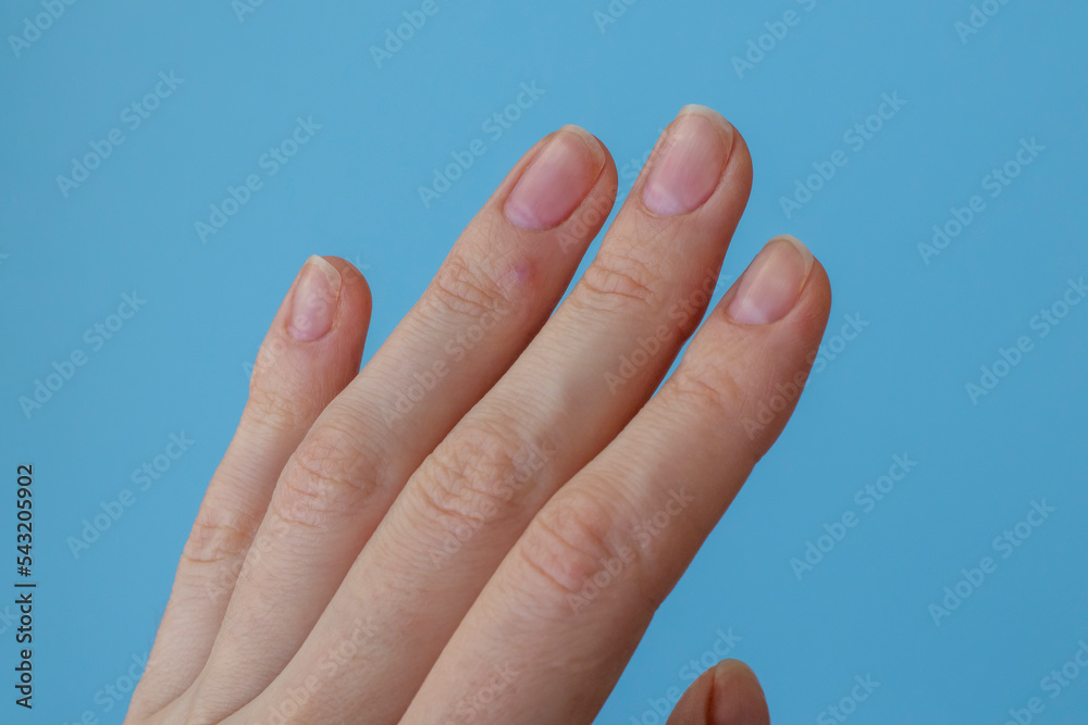 A wart on a woman's hand on the ring finger in the process of healing ...