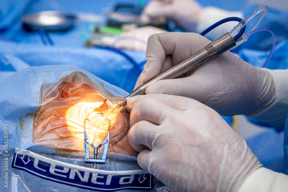 Phacoemulsification, destruction of the opaque lens by ultrasound ...