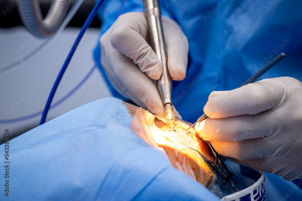 Phacoemulsification, destruction of the opaque lens by ultrasound ...