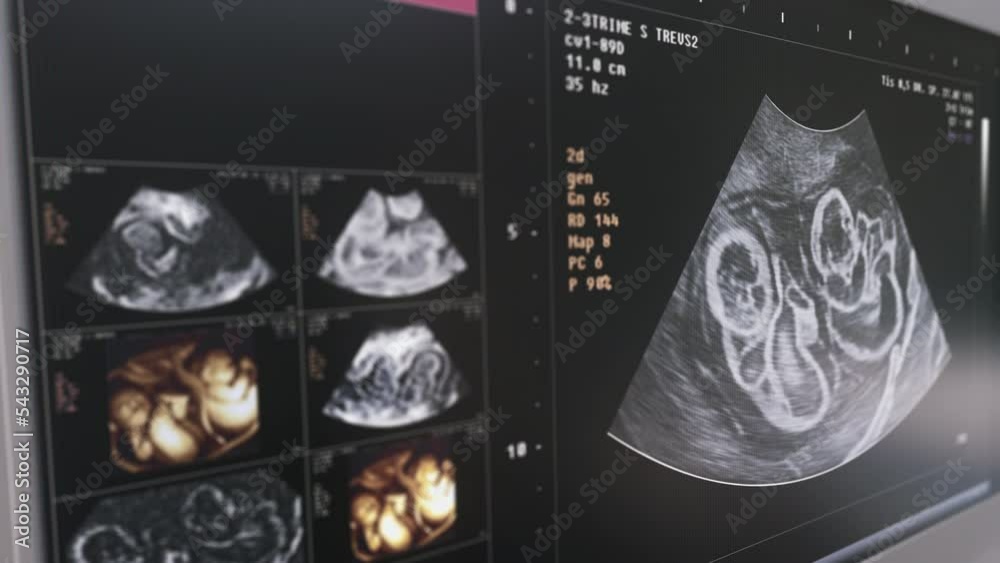 Checking Baby Twins Health Status In Ultrasound Device Display ...