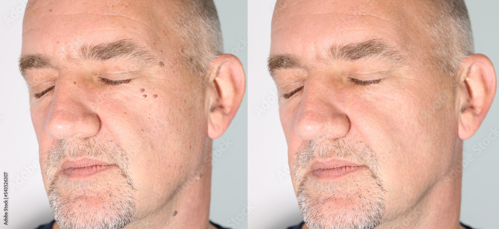 Comparison before and after skin laser treatment black spot on human ...