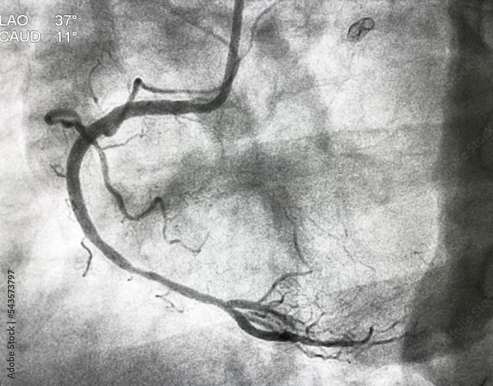 Coronary angiogram (CAG) of right coronary artery (RCA). Stock Photo ...