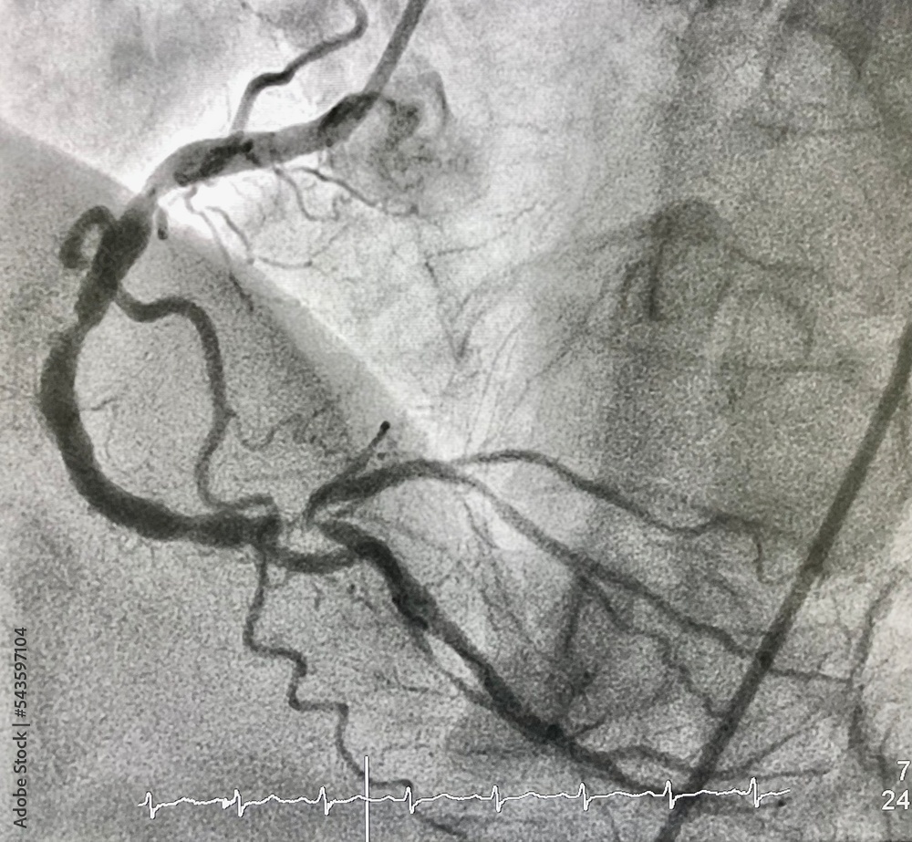Coronary angiogram (CAG) of right coronary artery (RCA). Stock Photo ...
