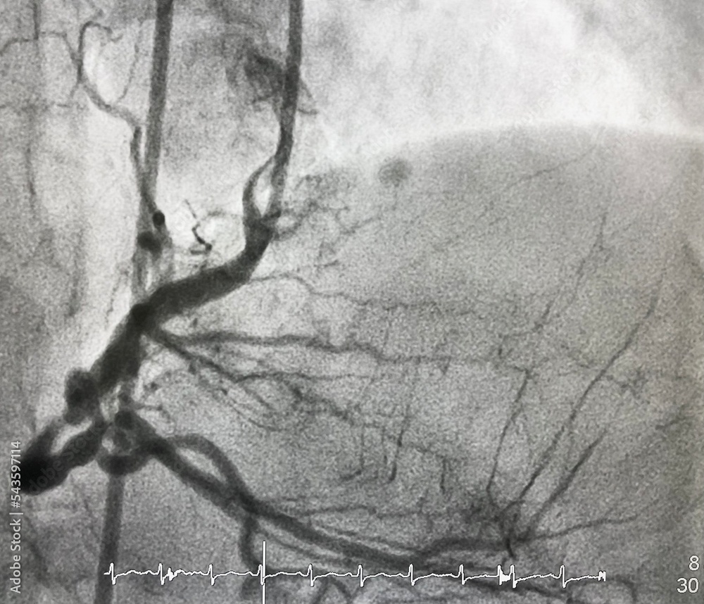 Plakat Coronary angiogram (CAG) shown right coronary artery stenosis ...