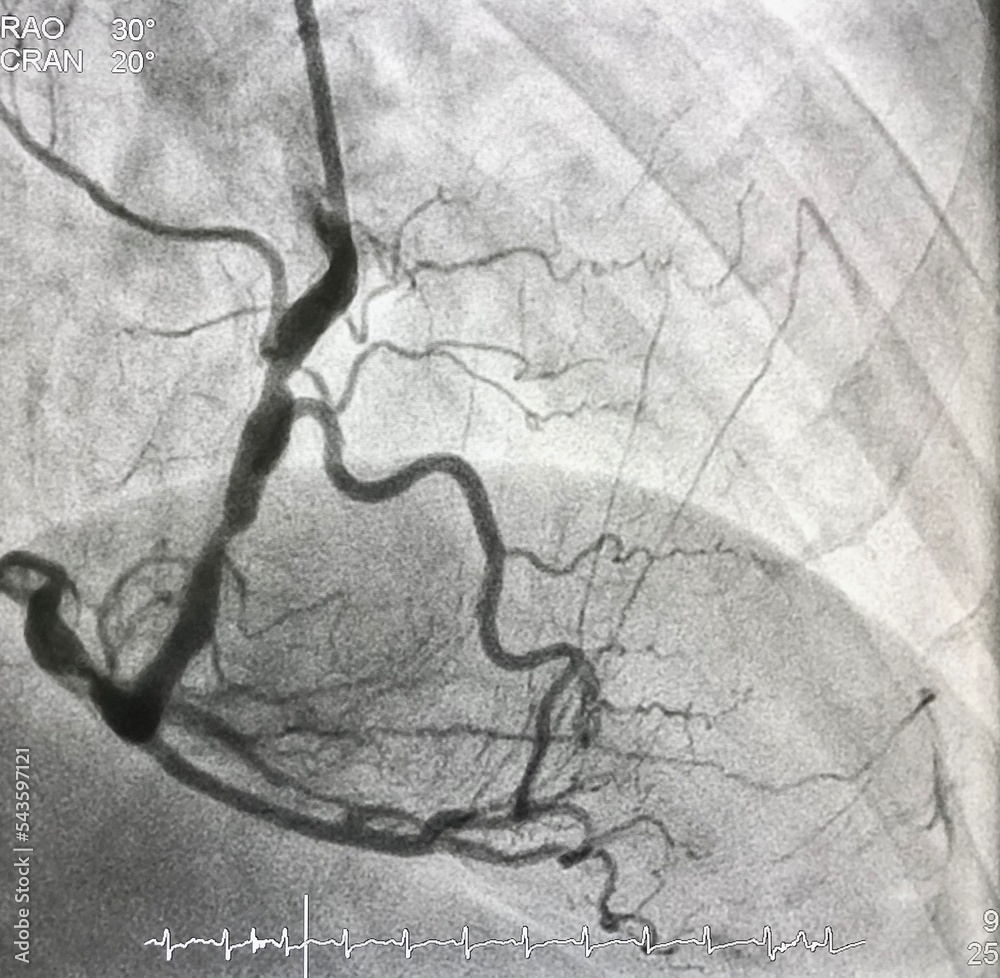 Coronary angiogram (CAG) shown right coronary artery stenosis and given ...