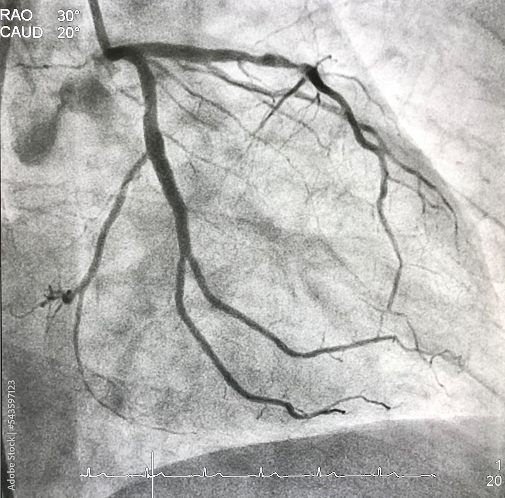 Coronary angiogram (CAG) of left coronary artery (LCA). Stock Photo ...