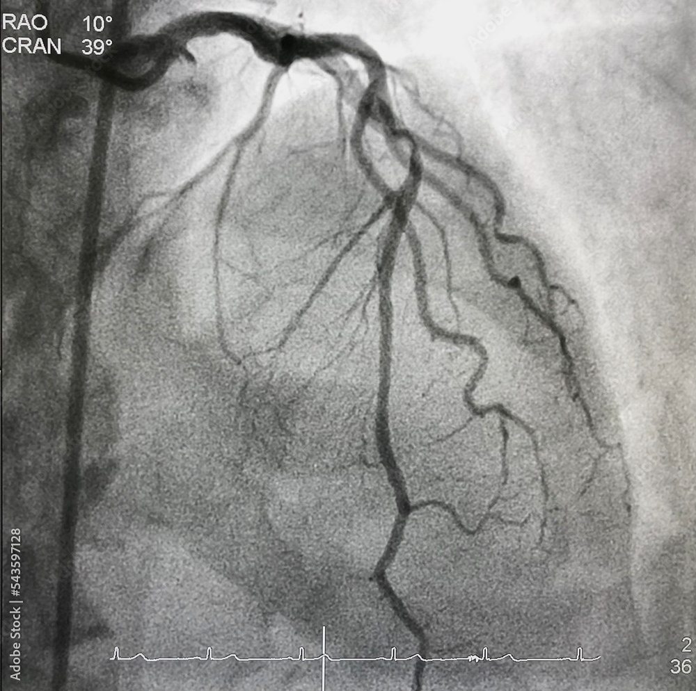 Coronary angiogram (CAG) of left coronary artery (LCA). Stock Photo ...