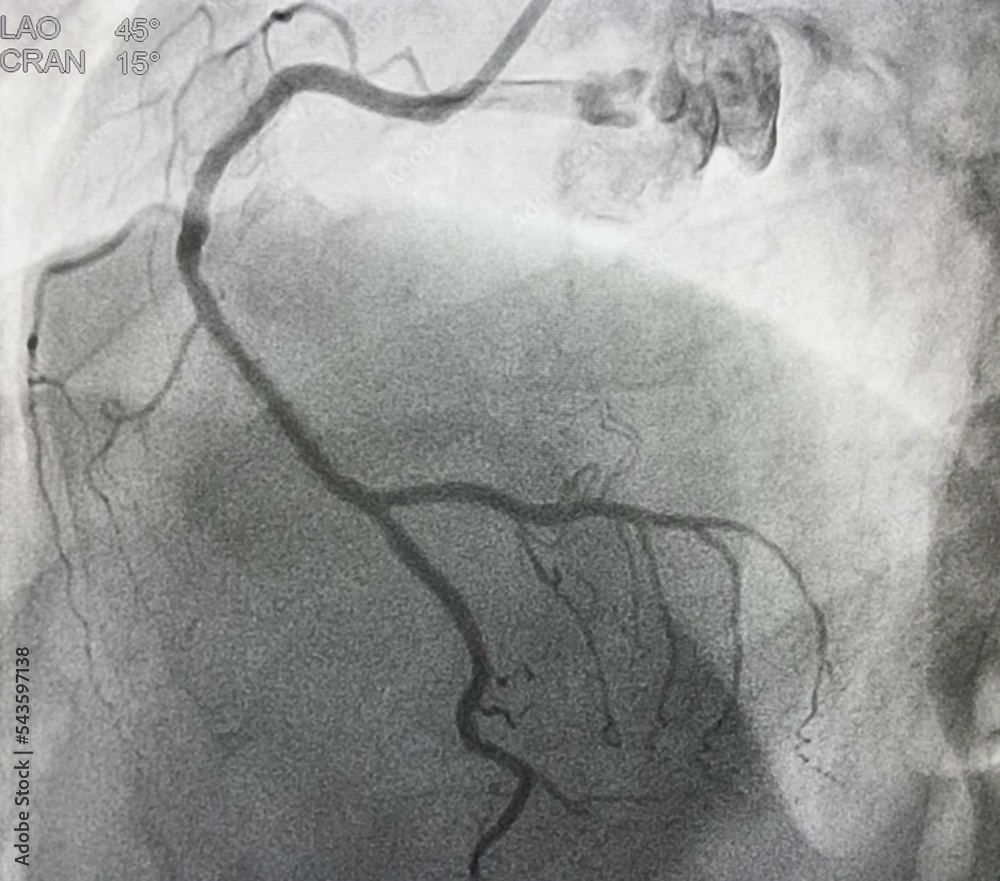 Coronary angiogram (CAG) of right coronary artery (RCA). Stock Photo ...
