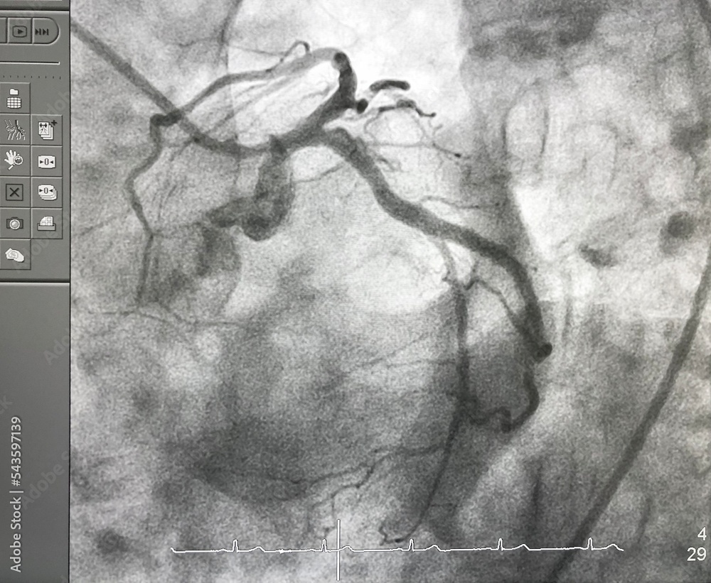 Coronary angiogram (CAG) of left coronary artery (LCA). Stock Photo ...