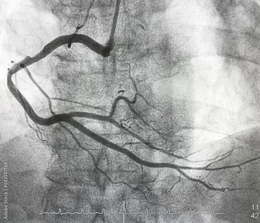 Coronary angiogram (CAG) of right coronary artery (RCA). Stock Photo ...