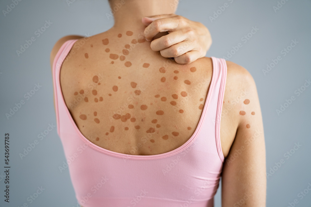Skin Rash And Itchy Back Acne ภาพถ่ายสต็อก | Adobe Stock